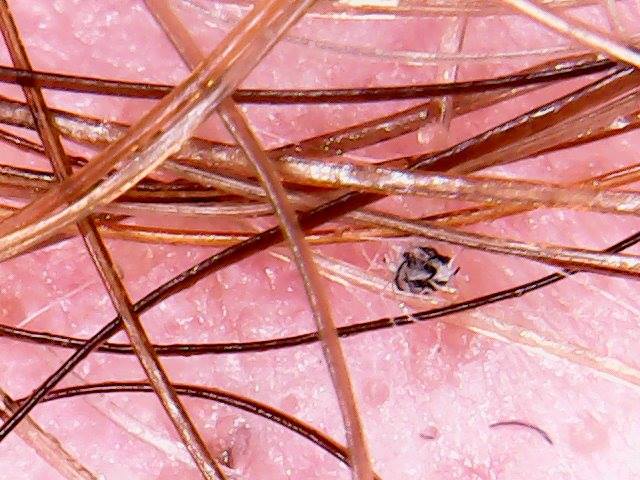 Morgellons Disease Blog, Morgellons Articles from Morgellons Survey